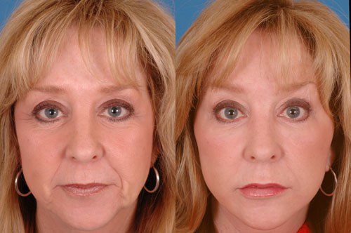 Revision Facelift Before And After Photos Dr Bassichis