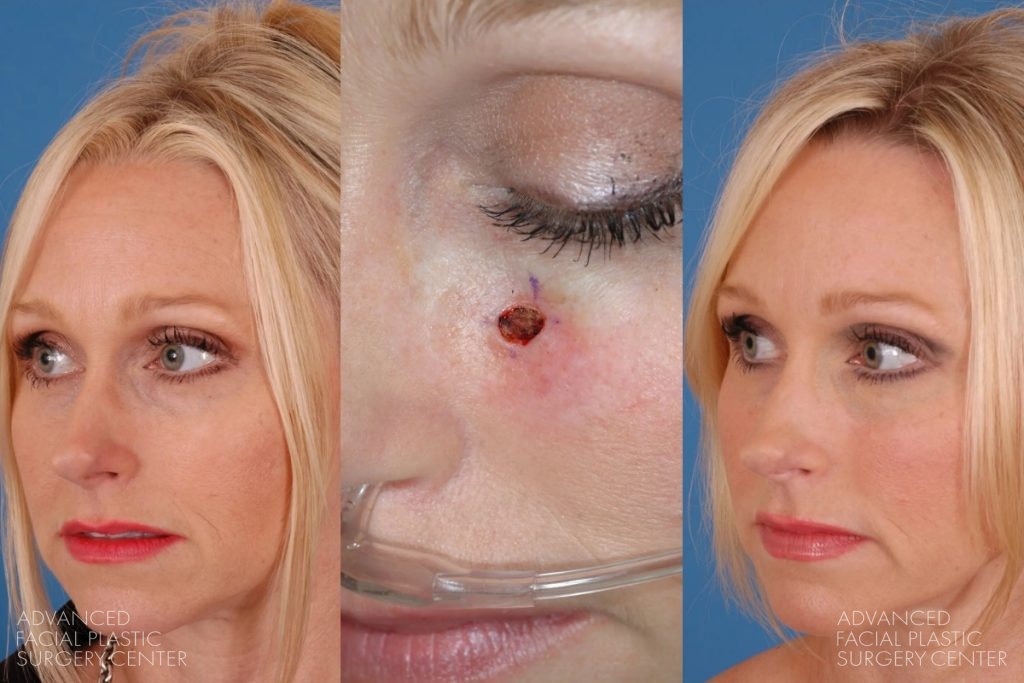 Skin Cancer Reconstruction Dallas | Advanced Facial Plastic Surgery
