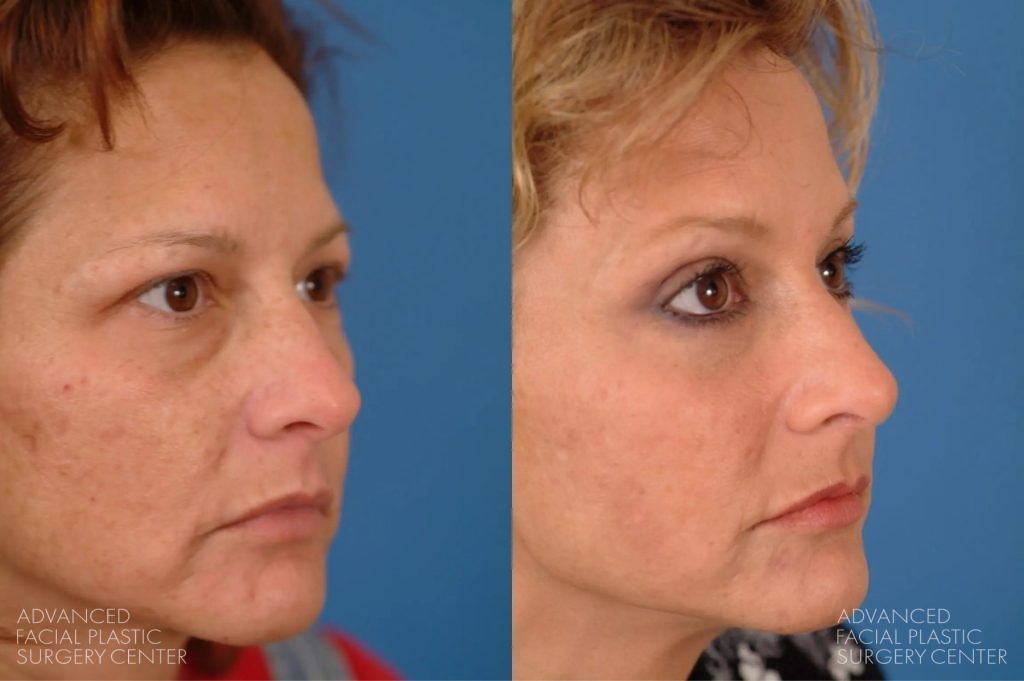 Midface Lift Dallas | Advanced Facial Plastic Surgery